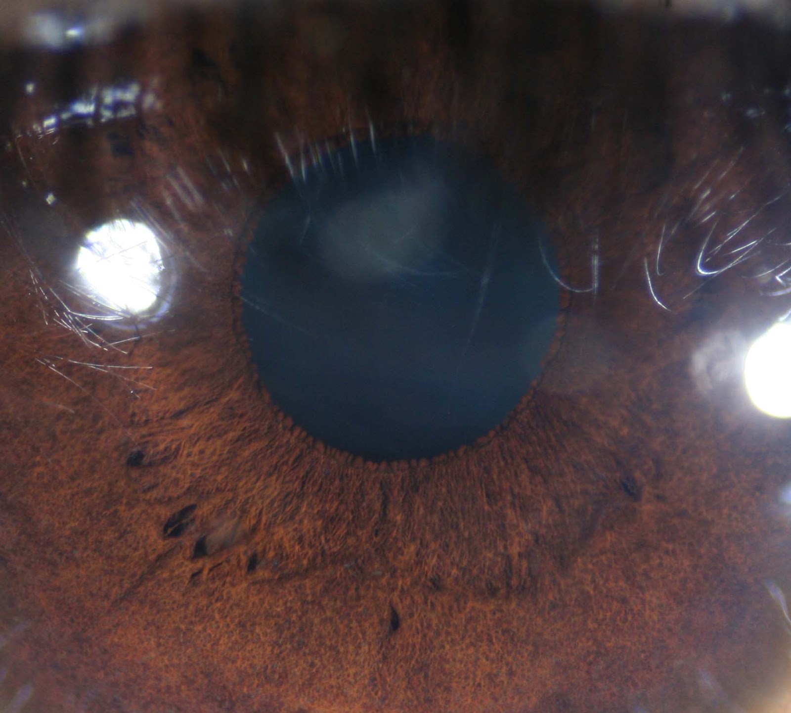 Modern & Multidimensional Iridology: Iris Signs at Internal & External ...
