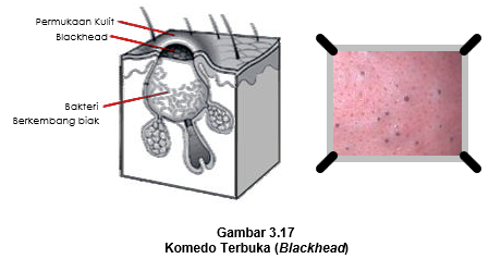 Pengertian Komedo dan Bentuk-Bentuk Komedo - PINTU BELAJAR CERDAS (PBC)