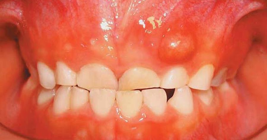 ¿QUÉ ES UNA FISTULA INTRAORAL? - 🦷Con Dientes - Salud Bucal