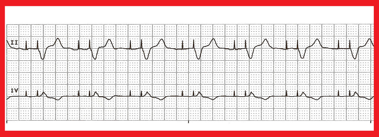 Various Dual Paced Rhythms