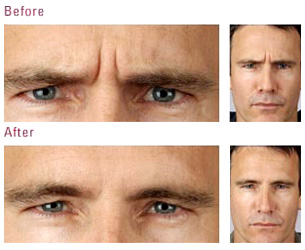 Non-Invasive And Natural Facelifts Using Face Aerobics Exercises: Anti ...