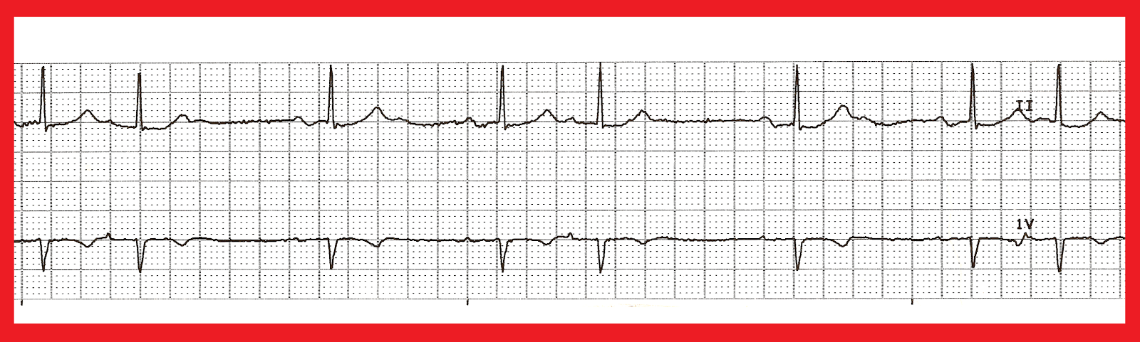 EKG Rhythm Quiz 216