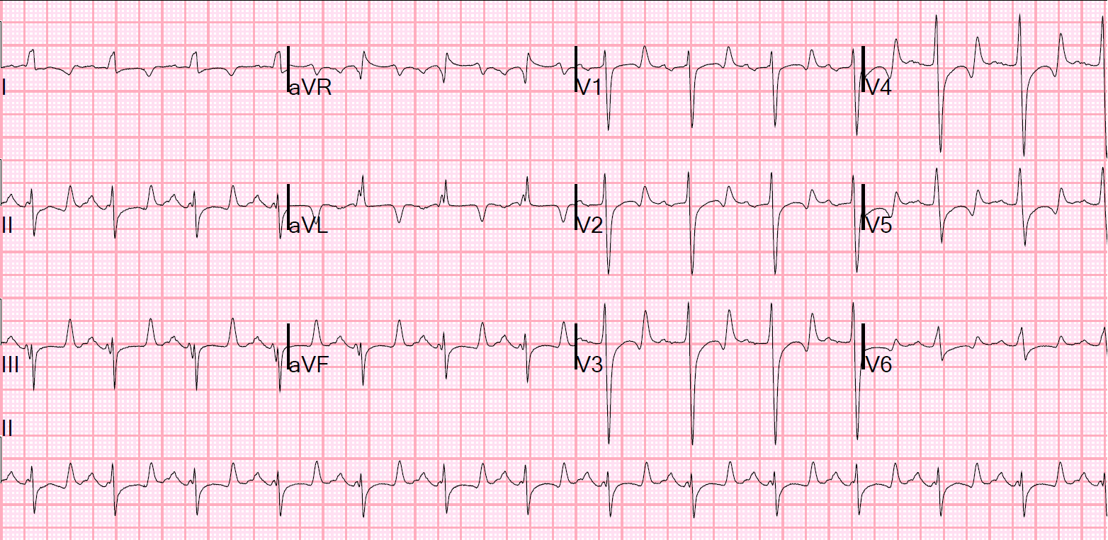Hypocalcemia Ekg