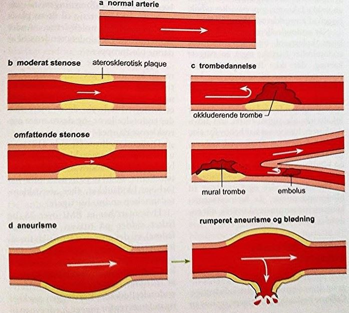 Familien Danmark: Hjertekarsygdomme