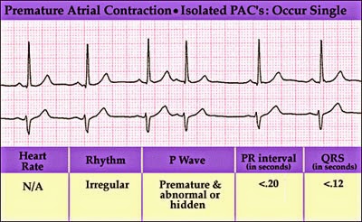 Premature Atrial Contraction / Atrial Ekstrasistol | INA - ECG