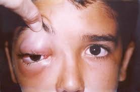 Sinusitis Understood: Complications of Sinusitis ( Orbital and ...