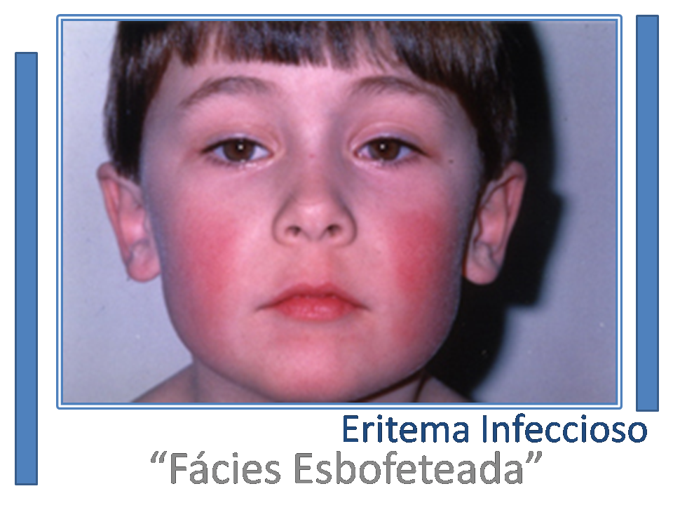 Eritema Infeccioso - "Fácies Esbofeteada"