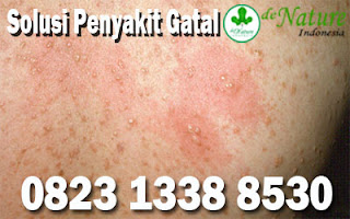Obat Herbal Gatal Scabies Paling Laris Terbukti Ampuh Permanen | Obat ...