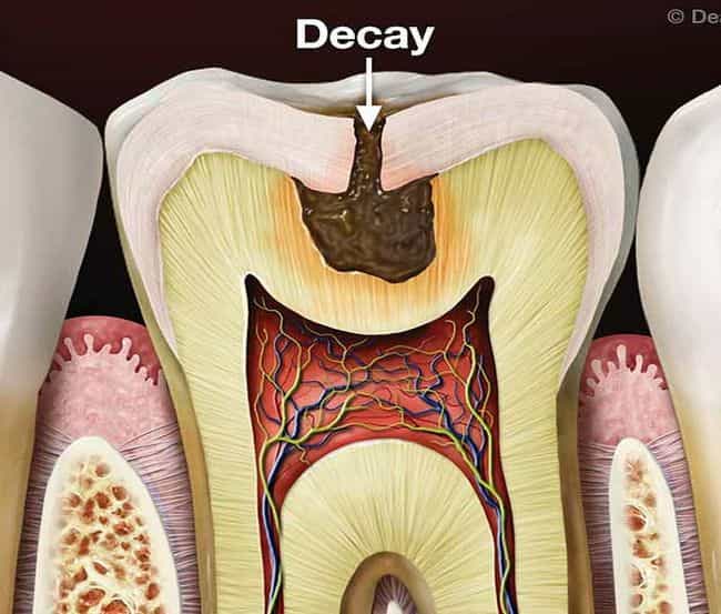 Tooth Decay : How it Happens and How to Avoid it | Directorio Odontológico