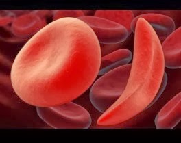 Mundo Biomédico - Angola: Anemia Falciforme