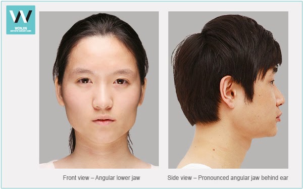 A beautiful and feminine jawline through square jaw reduction plastic ...