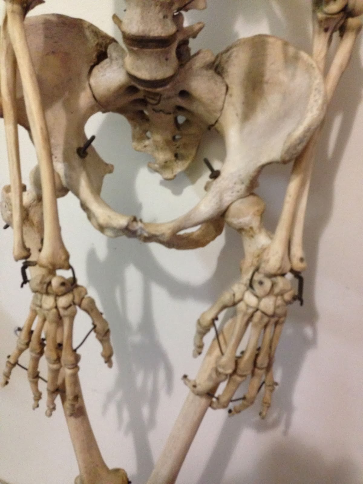 REAL HUMAN SKULLS AND SKELETAT BONES : Antique Genuine Authentic Real ...