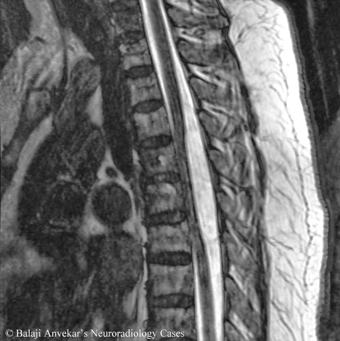 Dr Balaji Anvekar FRCR: Anterior Thoracic Spinal Cord Adhesion and ...