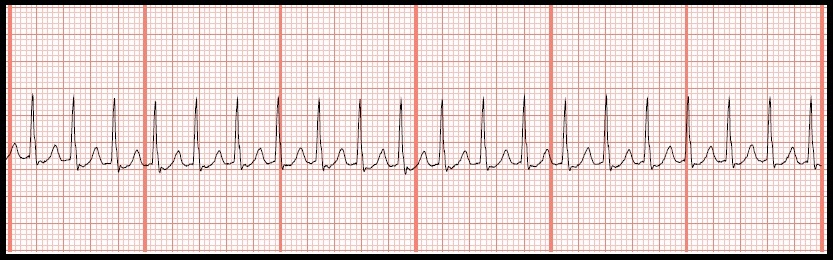 Practice EKG Rhythm Strips 118