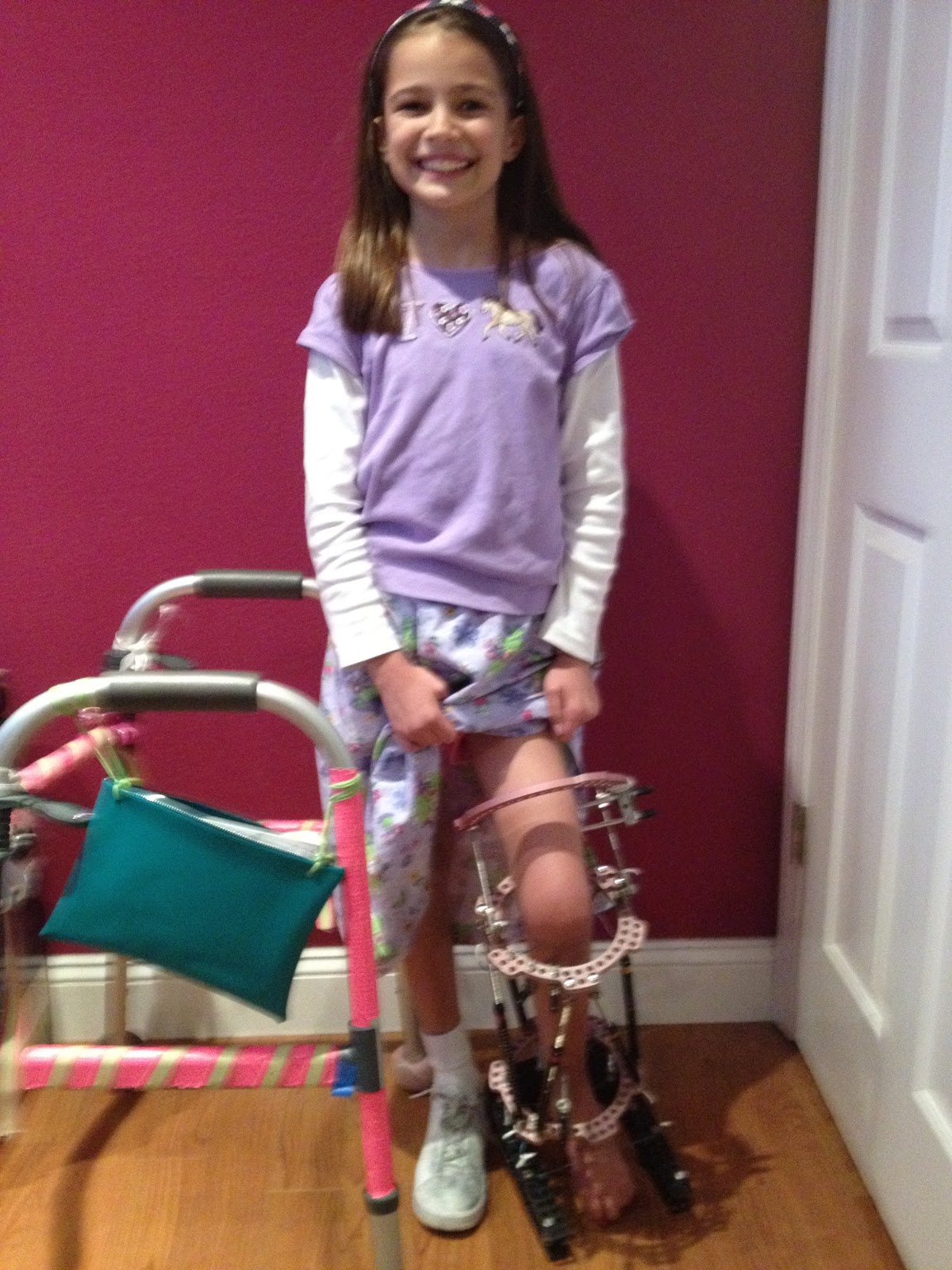 fibular hemimelia leg lengthening: Thigh Ring and Foot Plate removal ...