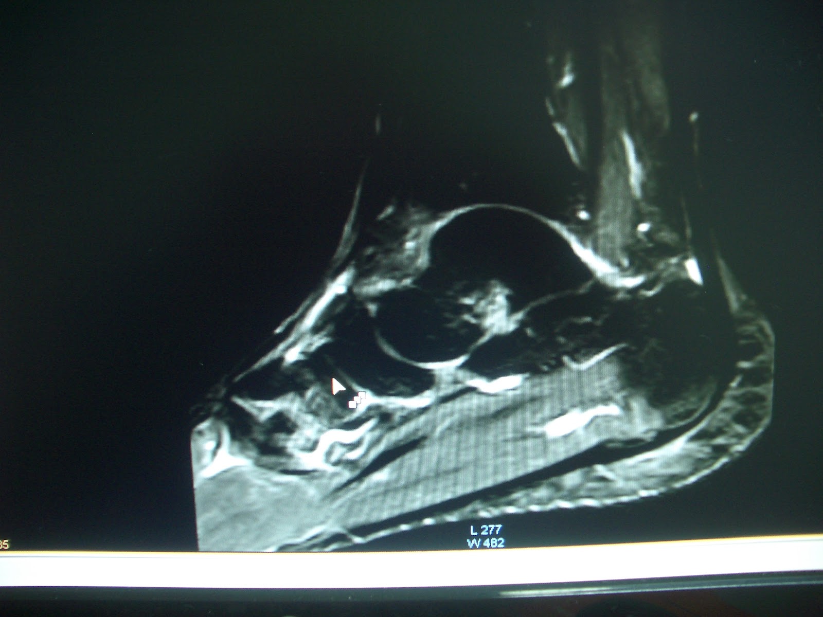 Podo Basas al Día: Fascitis plantar. Micosis intertriginosa. Papiloma ...