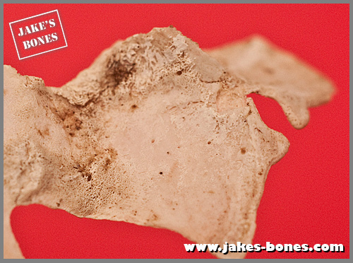 Strange bones #14: Two weird bone pathologies : Jake's Bones