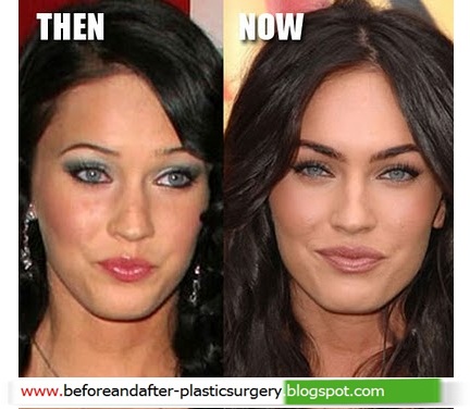 Megan Fox plastic surgery | Before and After Plastic Surgery Celebrity ...