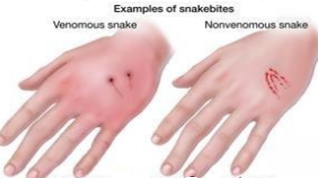 Renovate Biological: What is the Snake-bite and Types?