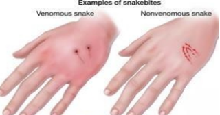 Renovate Biological: What is the Snake-bite and Types?