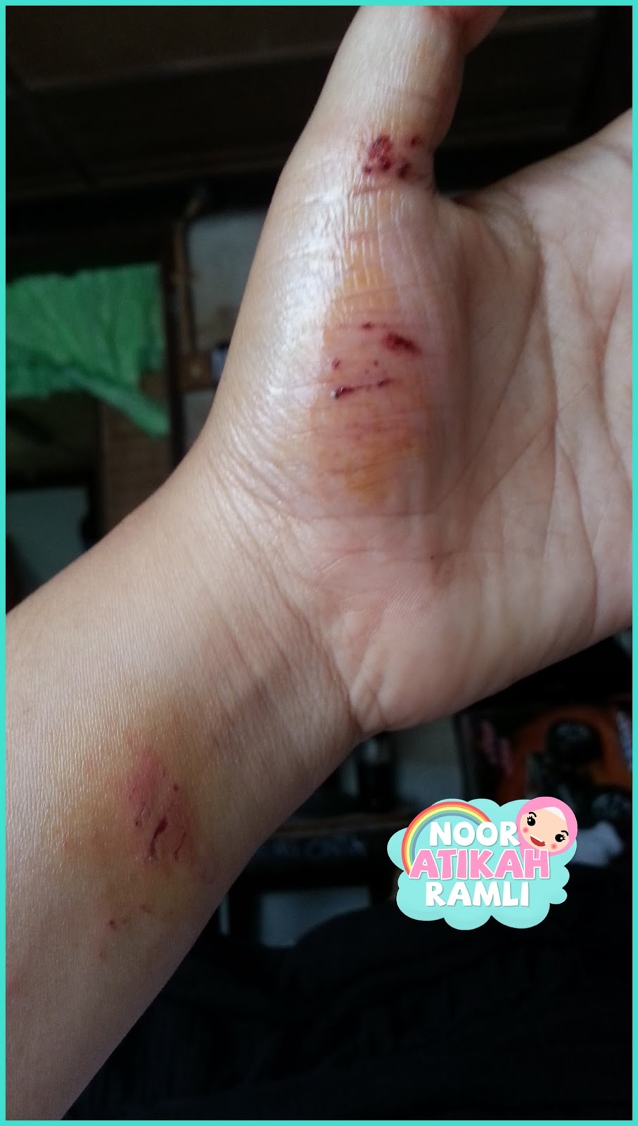 Tangan Jatuh Dari Motor - Perumperindo.co.id