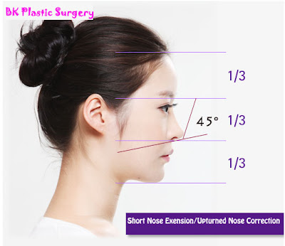 BK Plastic Surgery: [BK Plastic Surgery] Short Nose Extension/Upturned ...