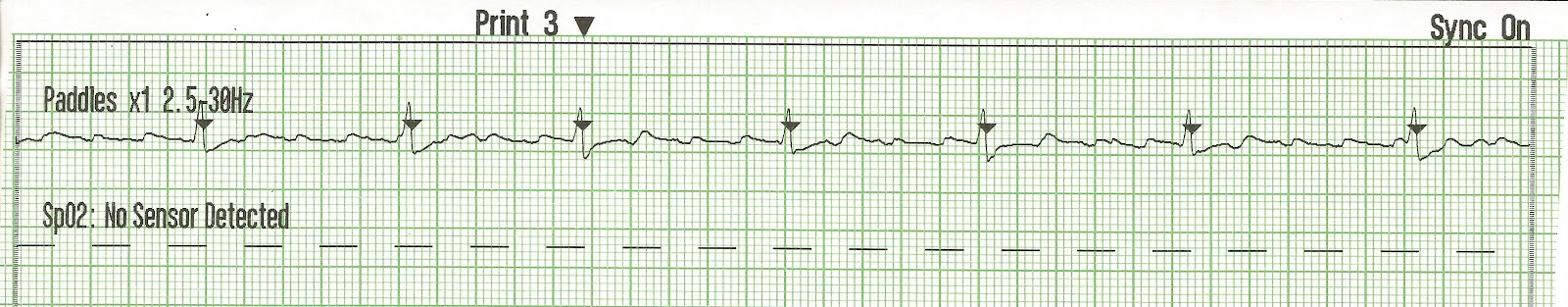 Float Nurse: ECG Rhythm Strips 86: Cardioversion of Atrial Flutter