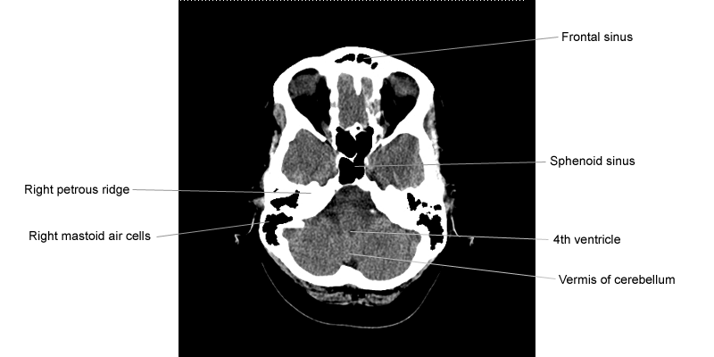 sinaune perawat: Gambaran Normal CT (Computed Tomography) Scaning ...