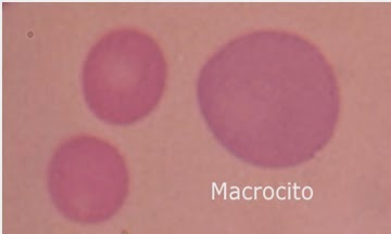 Fichero de Hematología: Anormalidades Eritrositarias.