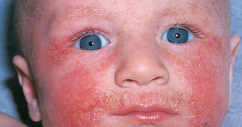 Your Skin for Life: Common Pediatric Dermatology Conditions Series ...