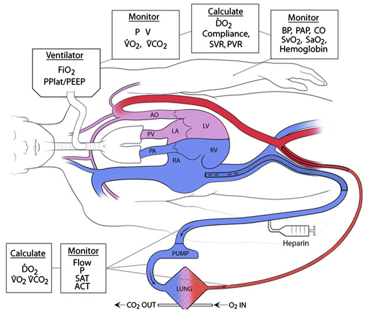 Manuali di Medicina Intensiva: ECMO ed accessi vascolari (Capitolo 12.5.2)
