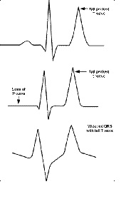 ACLS review: Pulseless Electrical Activity- part 7