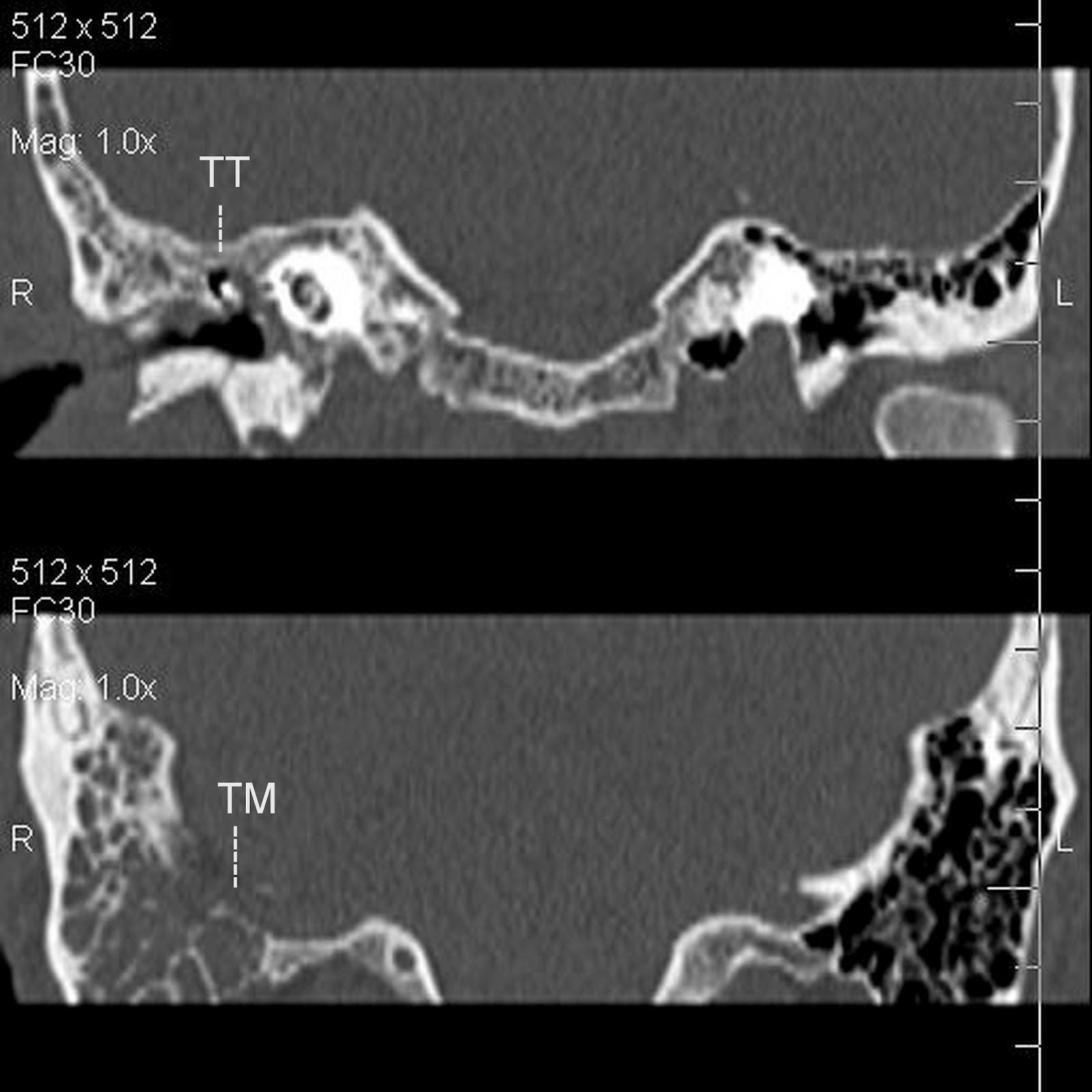 Dr Balaji Anvekar FRCR: Tegmen Plate