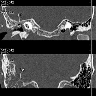 Dr Balaji Anvekar's Neuroradiology Cases: Tegmen Plate