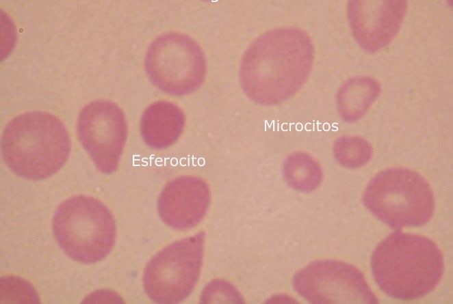 FICHERO DE HEMATOLOGÍA: ANORMALIDADES ERITROCITARIAS. Anormalidades en ...