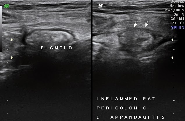 SONO DIGEST: EPIPLOIC APPENDAGITIS - An ultrasound diagnosis
