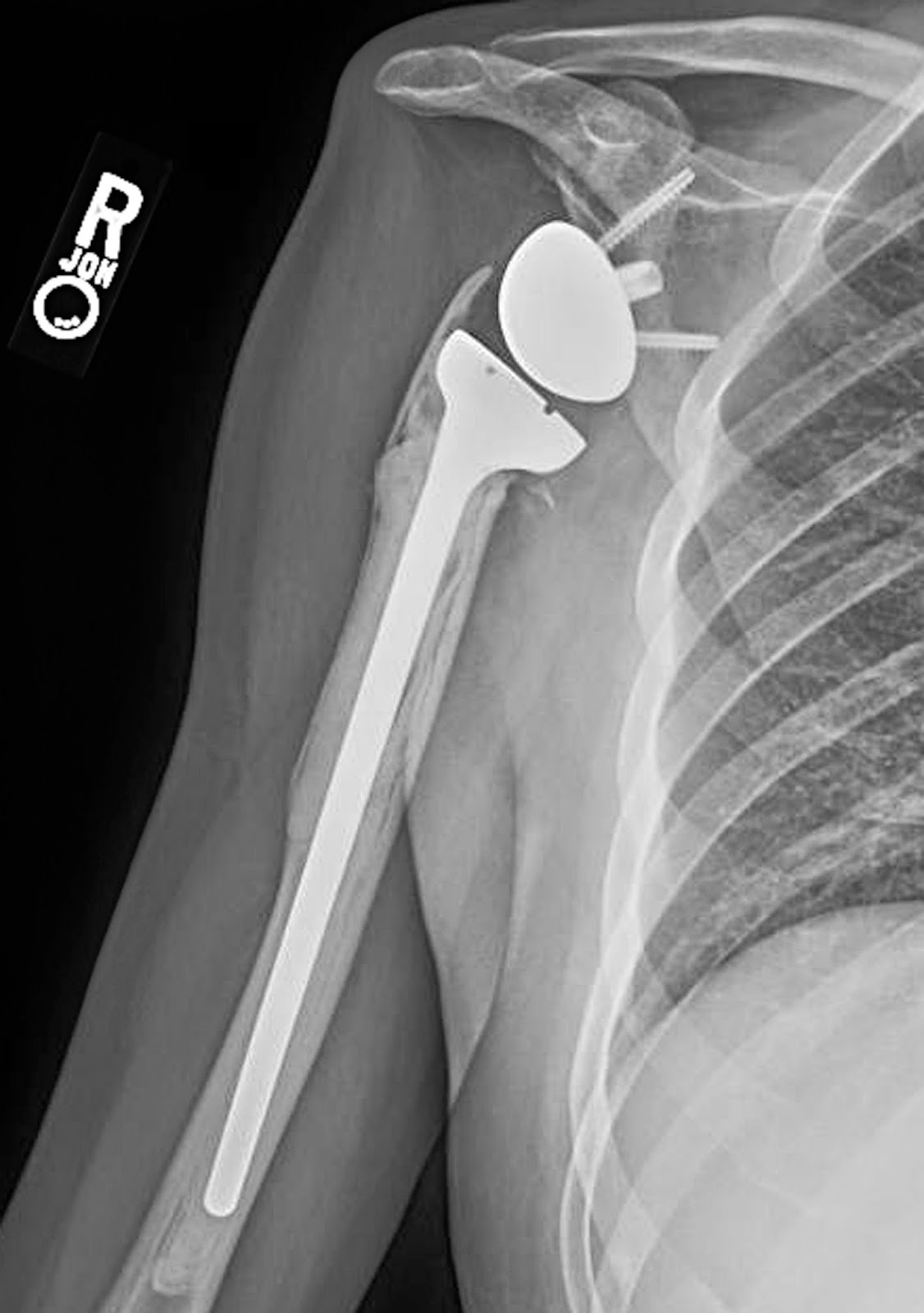 UW Shoulder and Elbow Academy: Reverse total shoulder joint replacement ...
