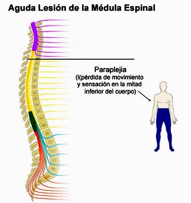 Accidentes de tráfico y consecuencias: Paraplejia, Hemiplejia ...