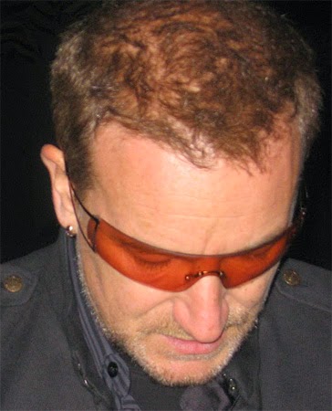 Bono Hair Transplant