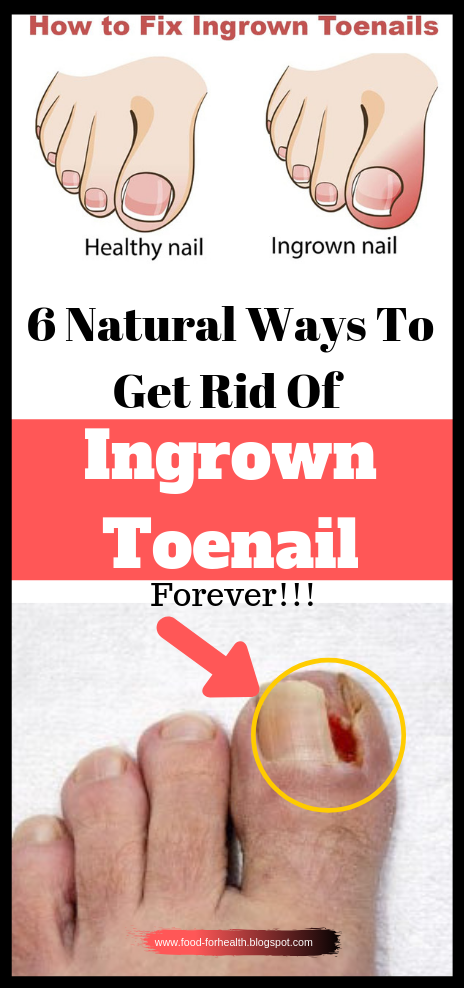 How To Get Rid Of Ingrown Toe Nail Pain Very Fast - Health Medical ...