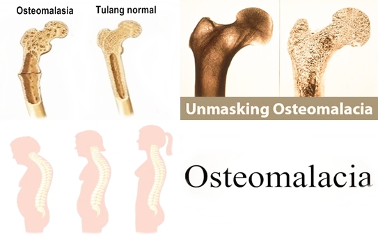 Pengobatan Herbal Osteomalasia ~ Gejala Pantangan dan Penyebab