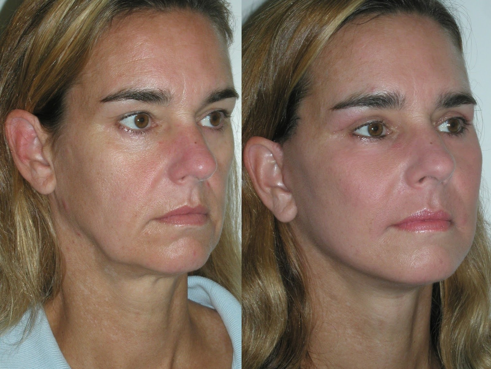 Fill Out And Expand Sunken Cheeks With Facial Aerobics Exercises