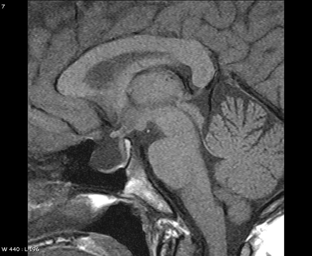 INRA: Sindrome de la silla turca y la importancia de la RMN