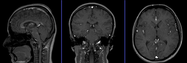 MRI Brain Planning ~ King's of Radiology