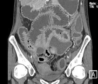 Hello USA: enteroclysis