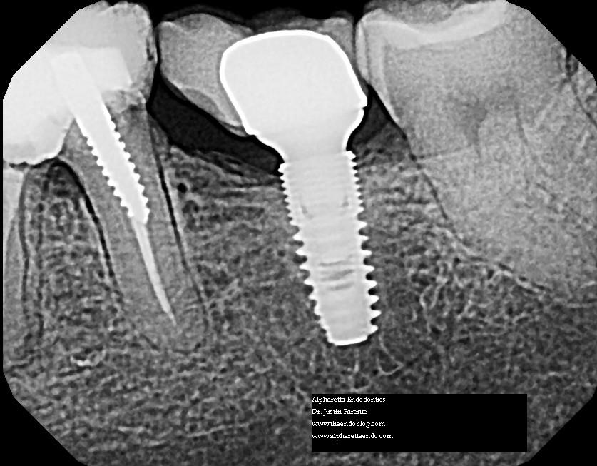 The Endo Blog: Consult Along: A Day at Alpharetta Endodontics