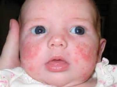 Tips Ajib: Penyebab Bintik Merah Pada Kulit Bayi