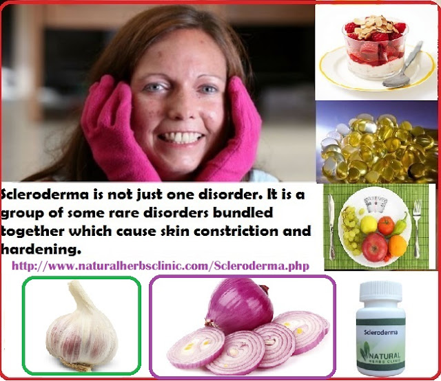 Scleroderma: a chronic systemic autoimmune skin disease