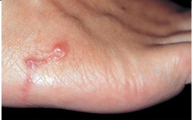 Creeping eruption, cutaneous larva migrans, cacing di kulit Medical ...