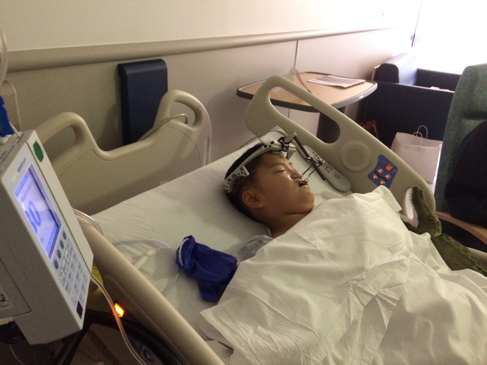 Henry: Midface Distraction Osteogenesis (1st Phase)